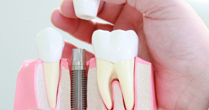 Prosthodontist FAQ | Dr. Jared Bowyer DDS