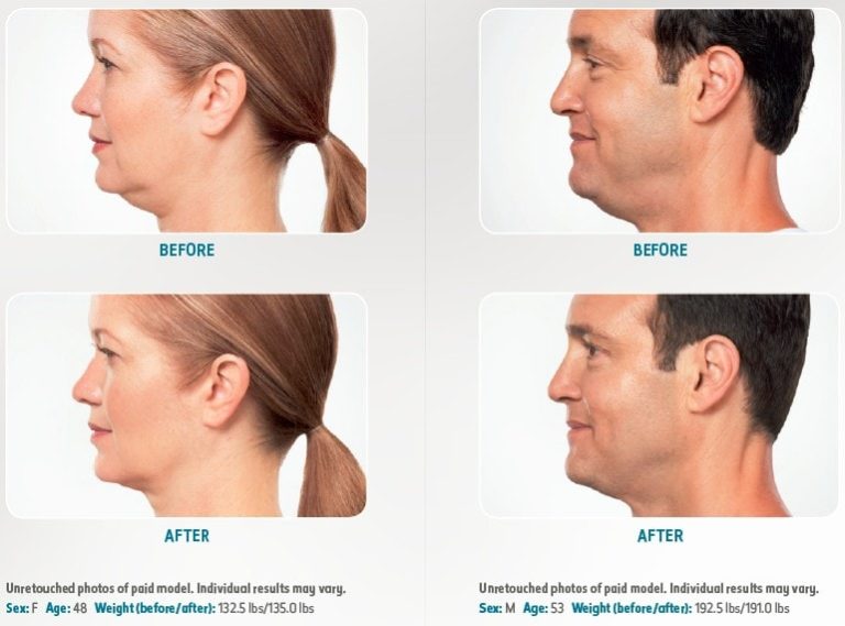 kybella-before-after | Dr. Jared Bowyer DDS