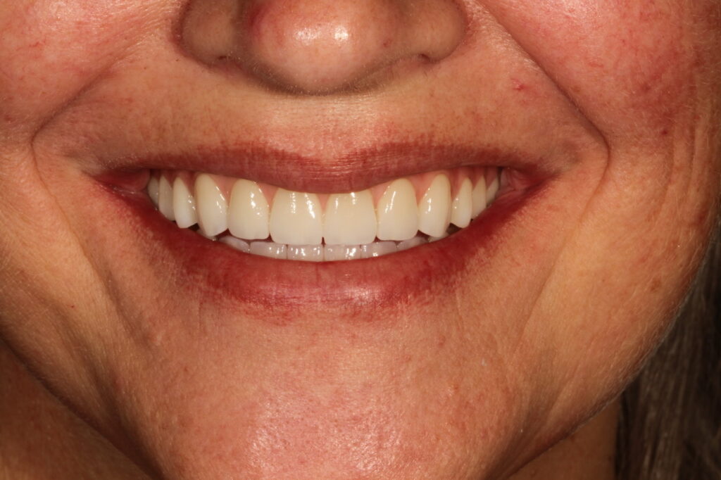 Modern Dentures: Why They Are a Better Solution Than You Think | Dr ...